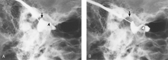 CONTRAST ARTHROGRAPHY | Radiology Key
