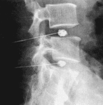 CENTRAL NERVOUS SYSTEM | Radiology Key