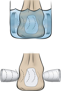 BONE DENSITOMETRY | Radiology Key