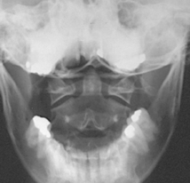 Vertebral Column | Radiology Key