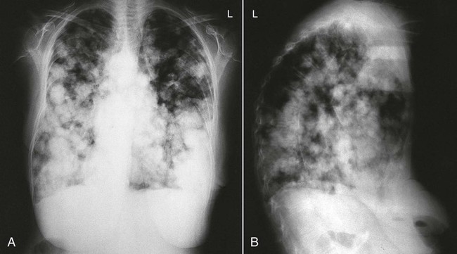 Respiratory System | Radiology Key