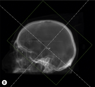 Tumours of the central nervous system | Radiology Key