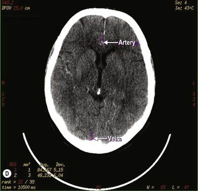 Imaging of vascular lesions of the head and neck – PZGI