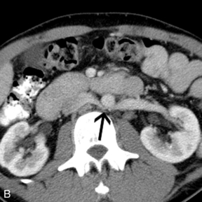 The Kidneys | Radiology Key