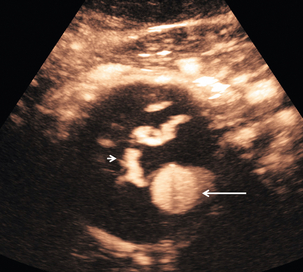 Microbubble Ultrasound Contrast Agents | Radiology Key