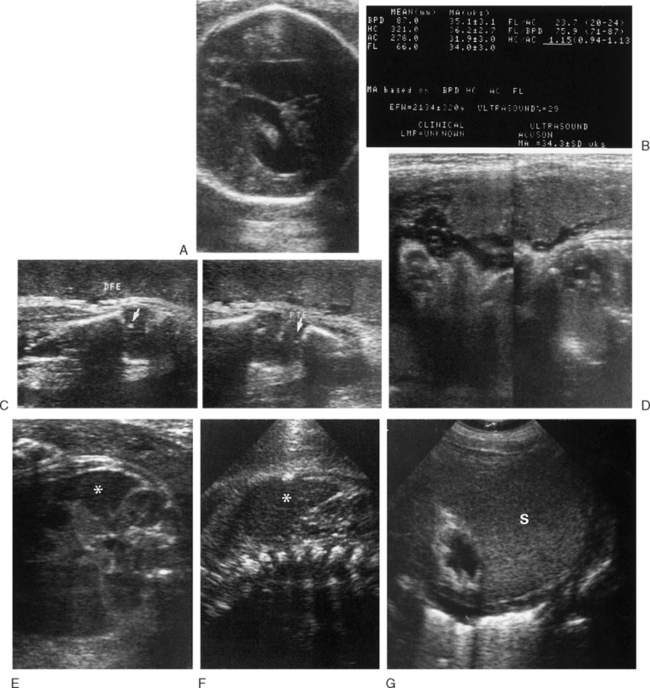 Estimating Fetal Gestational Age | Radiology Key