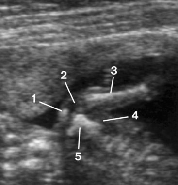 Ultrasound Evaluation Of The Uterus Radiology Key