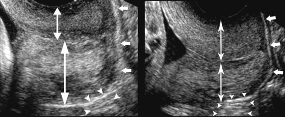 ULTRASOUND EVALUATION OF THE CERVIX | Radiology Key