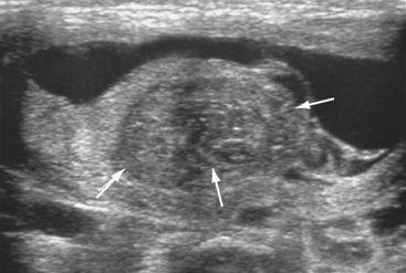 ULTRASOUND EVALUATION OF THE PLACENTA AND UMBILICAL CORD | Radiology Key