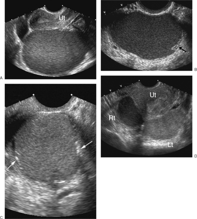 Ultrasound Evaluation Of The Adnexa Ovary And Fallopian