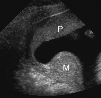 Uterus Contractions Early Pregnancy