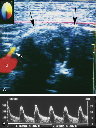 Ultrasound Assessment of the Abdominal Aorta | Radiology Key