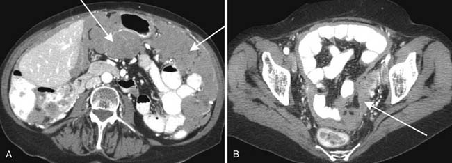 Peritoneal Cavity and Gastrointestinal Tract | Radiology Key