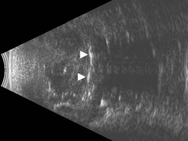 Vitreoretinal Diseases | Radiology Key
