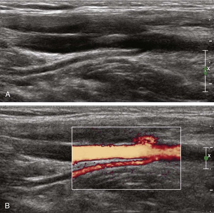 Doppler Imaging | Radiology Key