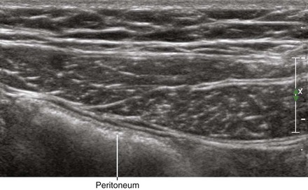 Peritoneum | Radiology Key