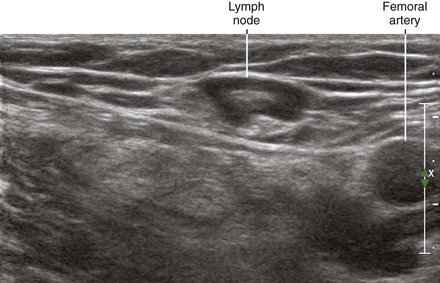 Lymph Nodes | Radiology Key