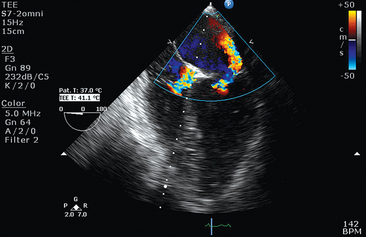 General chest ultrasound in neurocritical care | Radiology Key