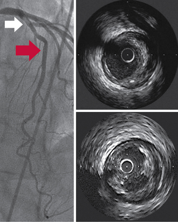 Intravascular ultrasound: (CONSULTANT-LEVEL EXAMINATION) | Radiology Key