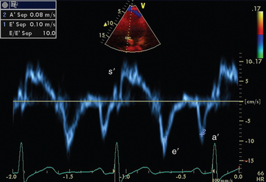 Transthoracic echocardiography: An overview | Radiology Key