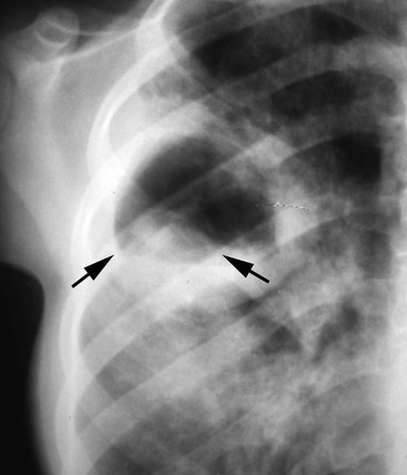 Pulmonary Infection in Adults | Radiology Key