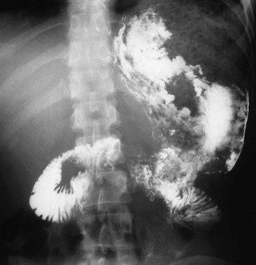 The Stomach | Radiology Key