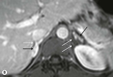 Adrenal Imaging | Radiology Key