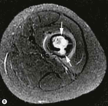 Bone Tumours (1) | Radiology Key