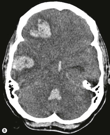 Intracranial Infections | Radiology Key