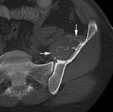 Bone Marrow Disorders | Radiology Key
