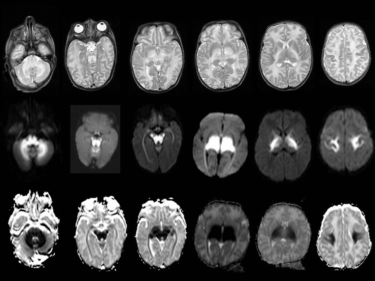 Paediatric Neuroradiology | Radiology Key