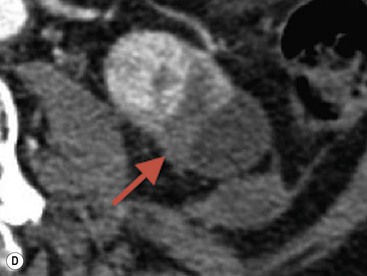 Image-Guided Biopsy and Ablation Techniques | Radiology Key