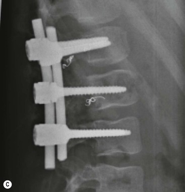 Spinal Interventions | Radiology Key