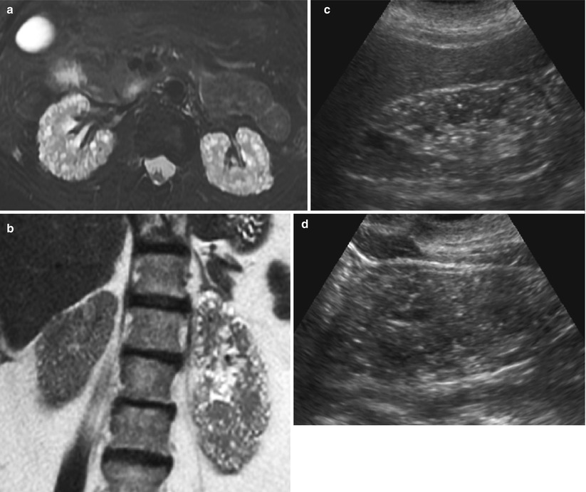 Cystic Disease | Radiology Key