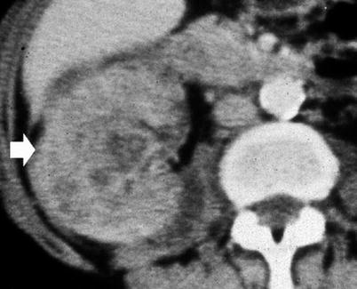 Renal Infections and Renal Fungal Infections | Radiology Key