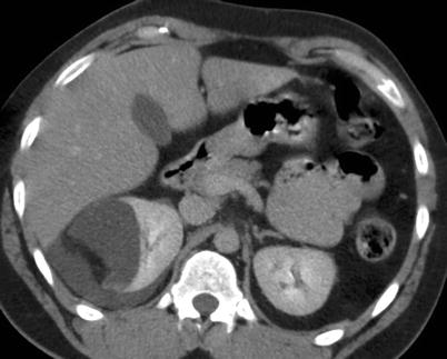 of Renal Trauma | Radiology Key