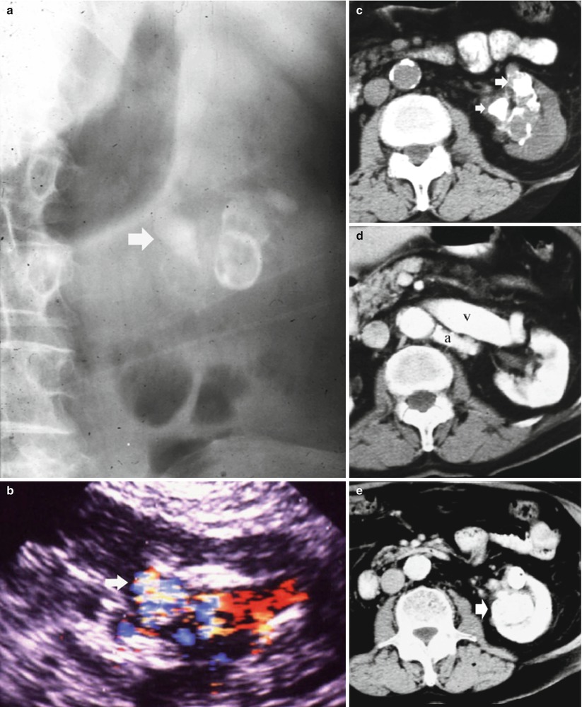 Solid Renal Tumors | Radiology Key