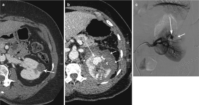 in Renal Cell Carcinoma | Radiology Key