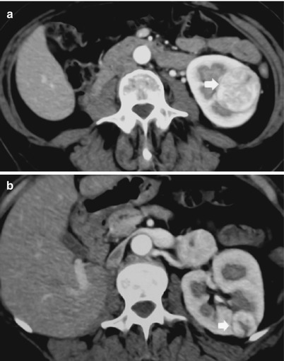 of the Postoperative Kidney | Radiology Key