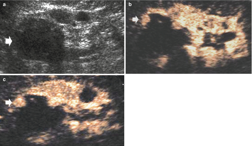 of the Kidney | Radiology Key