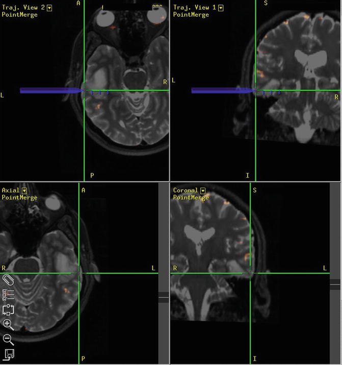 BOLD fMRI for Presurgical Planning: Part I | Radiology Key