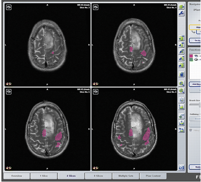 BOLD fMRI for Presurgical Planning: Part II | Radiology Key