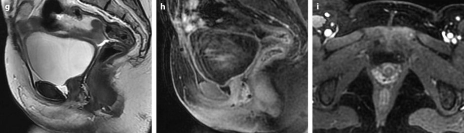 Benign and Malignant Endometrium | Radiology Key