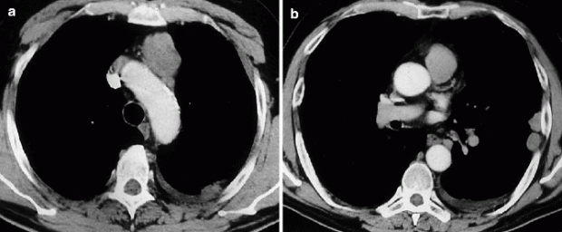 Dysfunctional Disorders of the Pharynx and the Esophagus: VFSS and ...