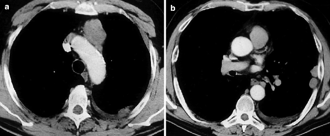 Pleural Disease | Radiology Key