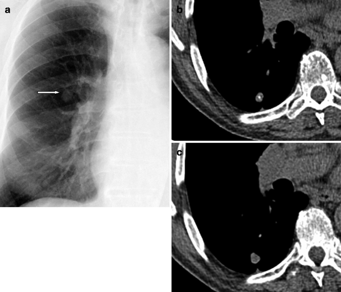 Neoplastic Disease | Radiology Key