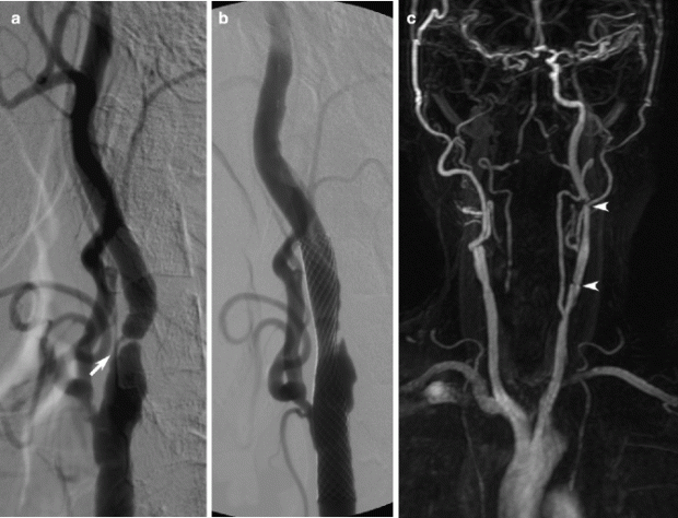 Percutaneous Abscess Drainage | Radiology Key