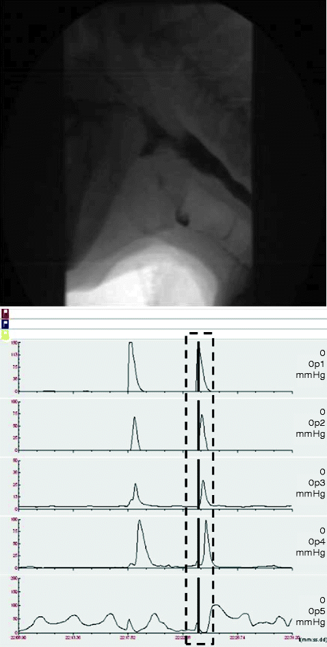 Dysfunctional Disorders of the Pharynx and the Esophagus: VFSS and ...