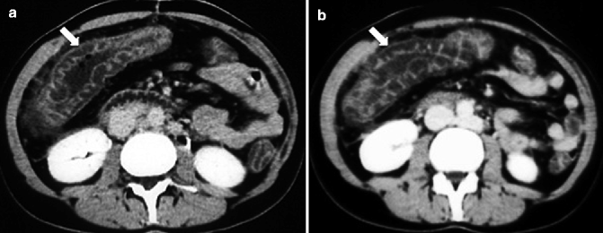 Ischemic Bowel Disease | Radiology Key