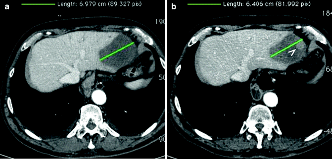 Gastrointestinal Tumors | Radiology Key